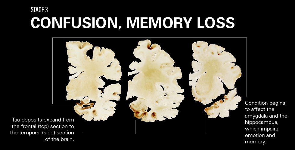 Brain Injury Resources CTE & Football (chronic traumatic encephalopathy ...
